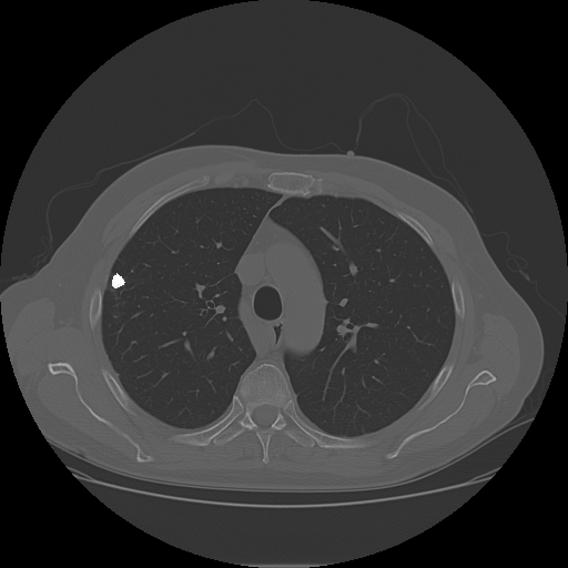 Nodule Severity Detection Object Detection Dataset And Pre Trained