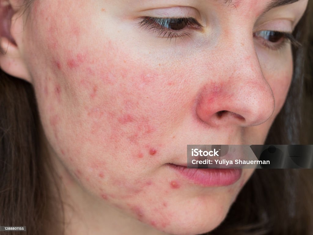 acnes_face Instance Segmentation Model by skin