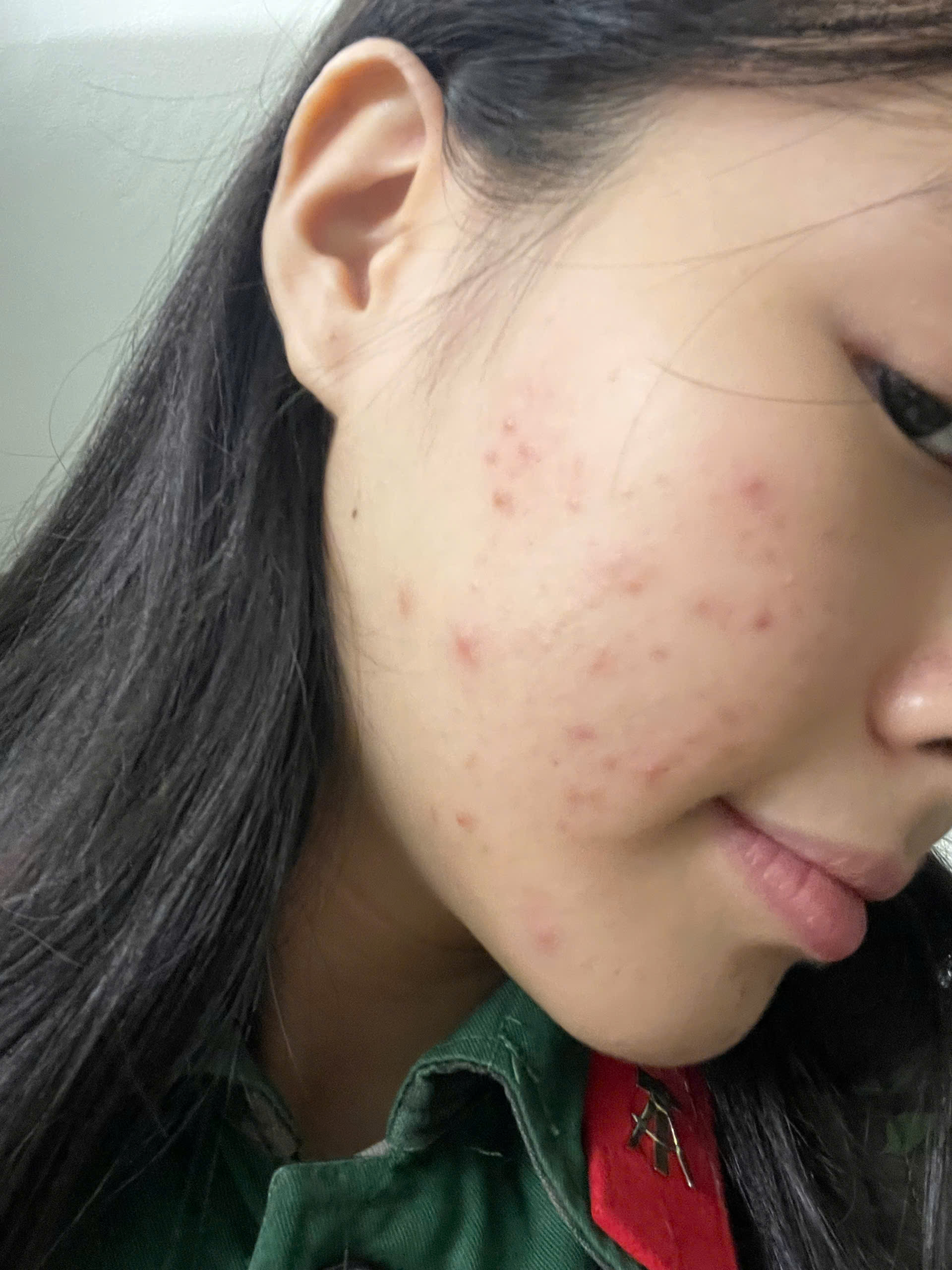 How to Use the acne_v3 Instance Segmentation API