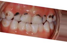 Dental Disease Detection Object Detection Model By Rakshitha M S