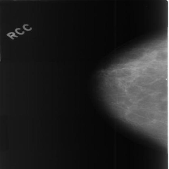 Cancer In Mammogram Object Detection Model V1 2023 12 10 10 43am By
