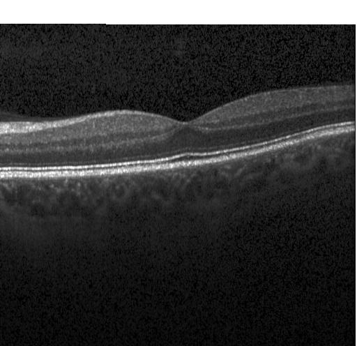 Retinal diesease classification Classification Model by DIP Project