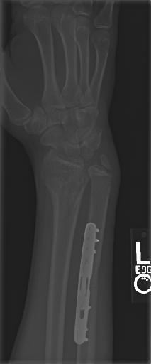 Bone Fracture Yolov8 Object Detection Dataset By Neuralnetwork