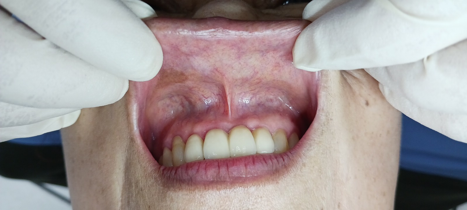 Oral App Object Detection Dataset By Mouth Detection