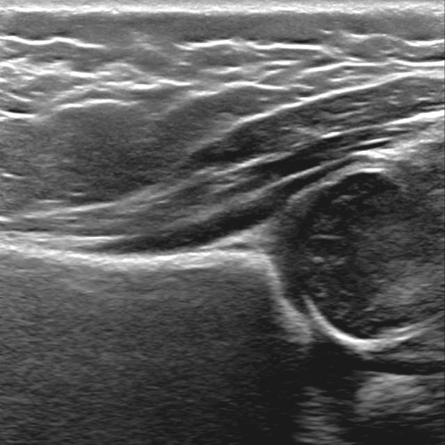 Hip_Segmentation Instance Segmentation Model by WorkPlayGround