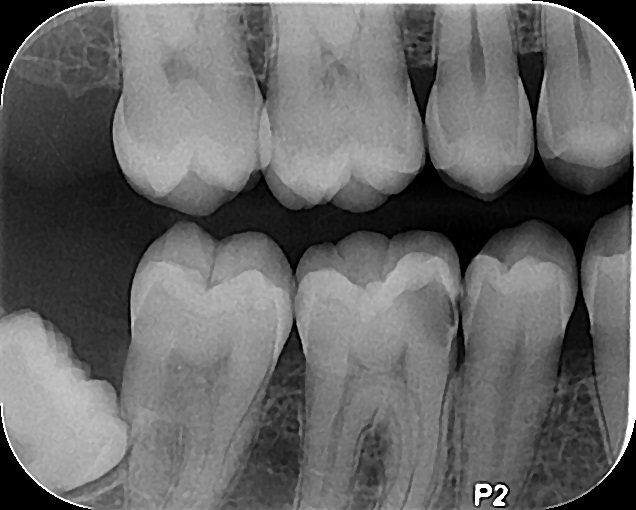Caries Instance Segmentation Dataset (v1, 2024-09-09 10:04am) by mmm