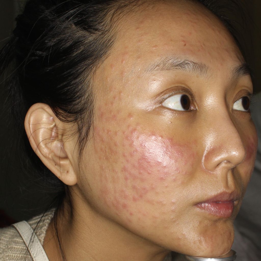 acne Classification Model by acne