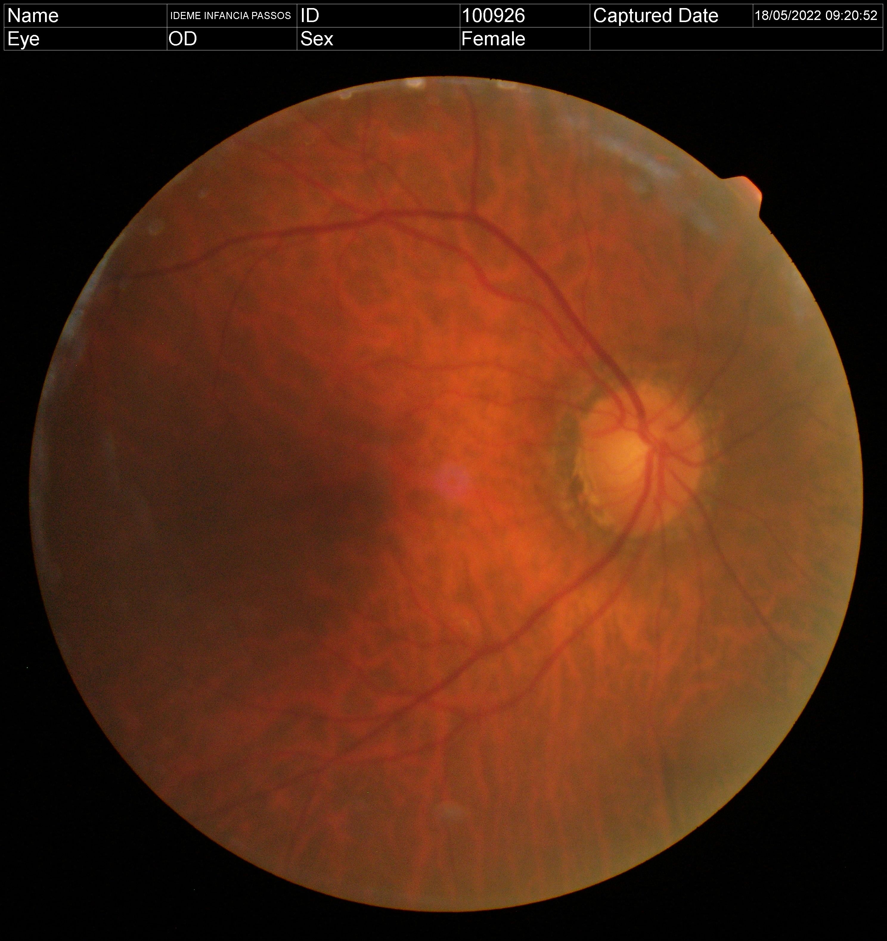 Retinas Object Detection Model by testegustavo