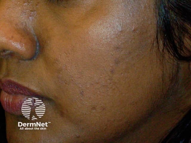 acne scars Object Detection Dataset by deteksi