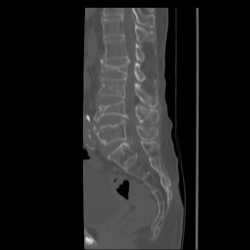 new_spine_fracture Object Detection Dataset by Nation Yulin college