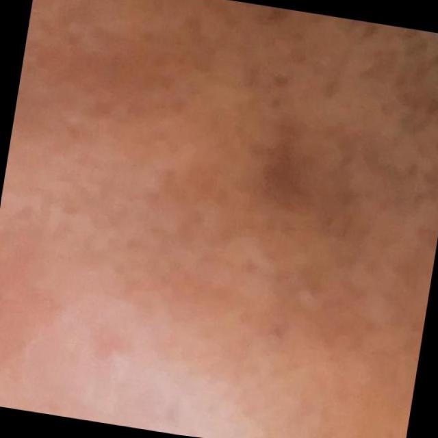 acne Instance Segmentation Model by Deep Learning