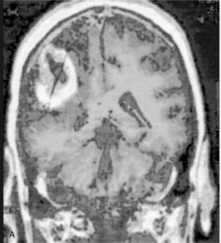 detection tumor Object Detection Dataset by hassen mh
