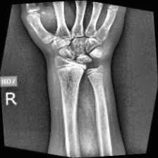 bone fracture detection Object Detection Model (v3, 2023-12-27 10:51am) by fyp