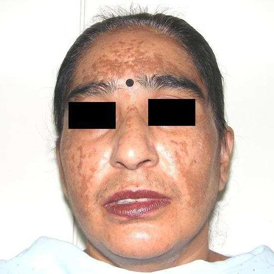 Melasma Detection Classification Model by task