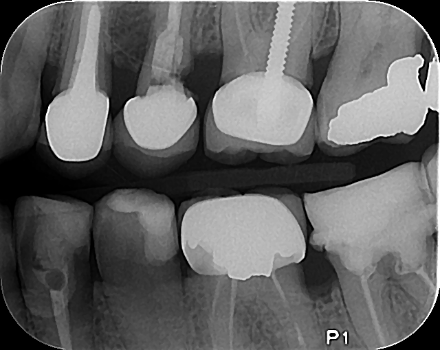 Caries Instance Segmentation Dataset by Cvat
