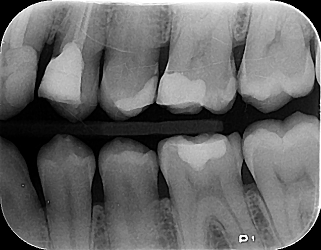 Caries Instance Segmentation Model (v10, 2024-06-24 4:28pm) by Cvat