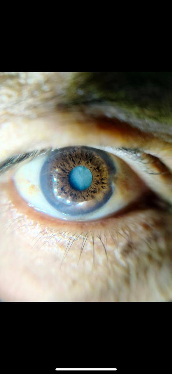 Pupil Mature Train Object Detection Dataset By Cataract Detection