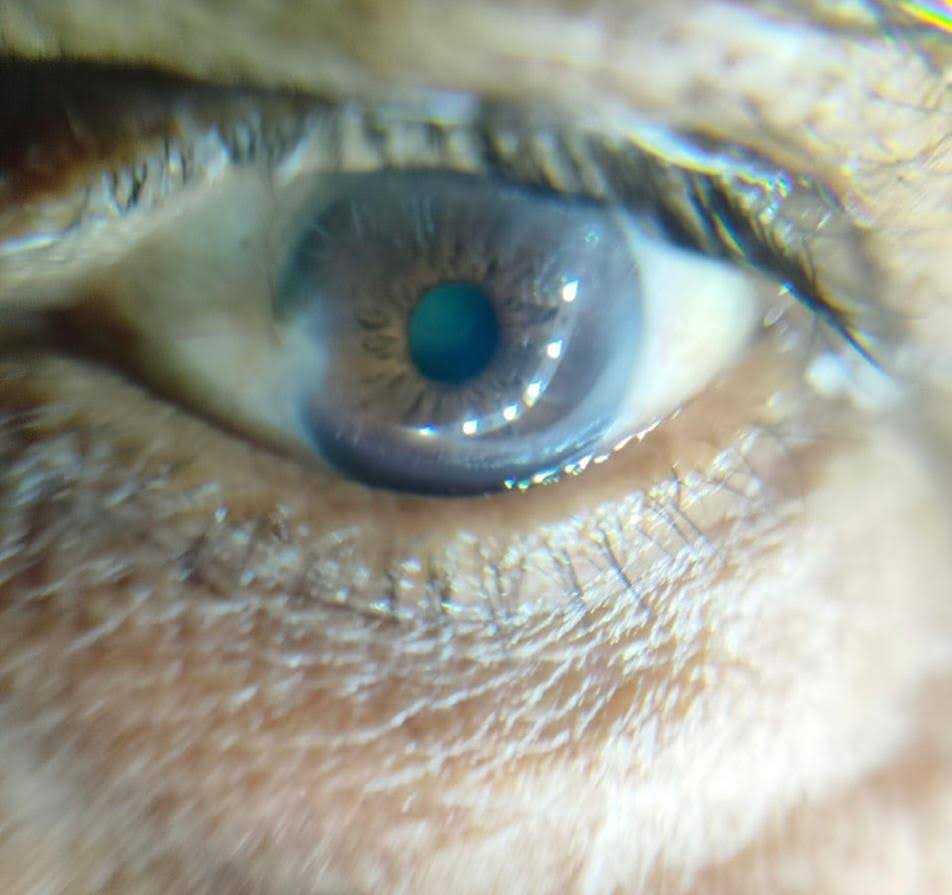 Pupil Medium Train Object Detection Dataset By Cataract Detection