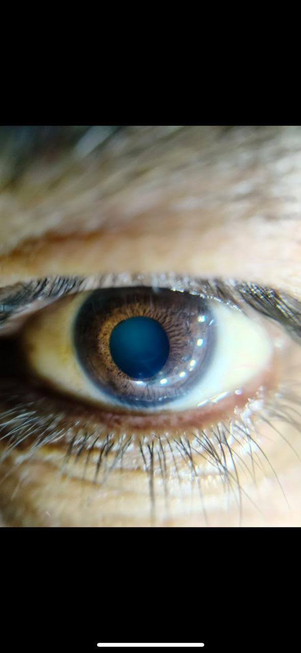 Pupil Mature Train Iris Object Detection Dataset By Cataract Detection