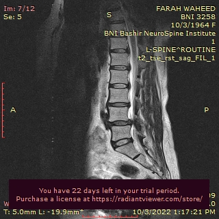 LUMBAR SPINE Instance Segmentation Dataset by Rakkurt