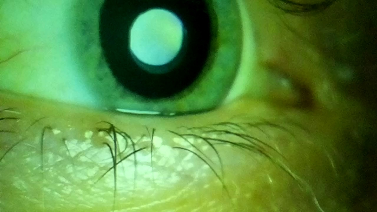 Pupil Tracking Instance Segmentation Model by Elite Hacker