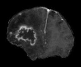 Brain_Tumor_v2 Object Detection Dataset by Objectdetection