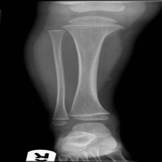 Classification Classification Model (v2, 2024-04-25 3:44am) by Bone Vision
