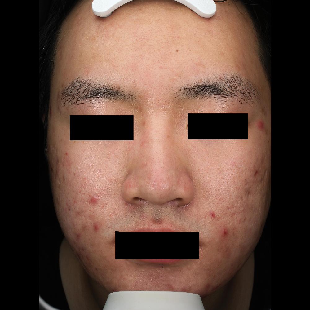 Acne Detection 2 Object Detection Dataset And Pre Trained Model By