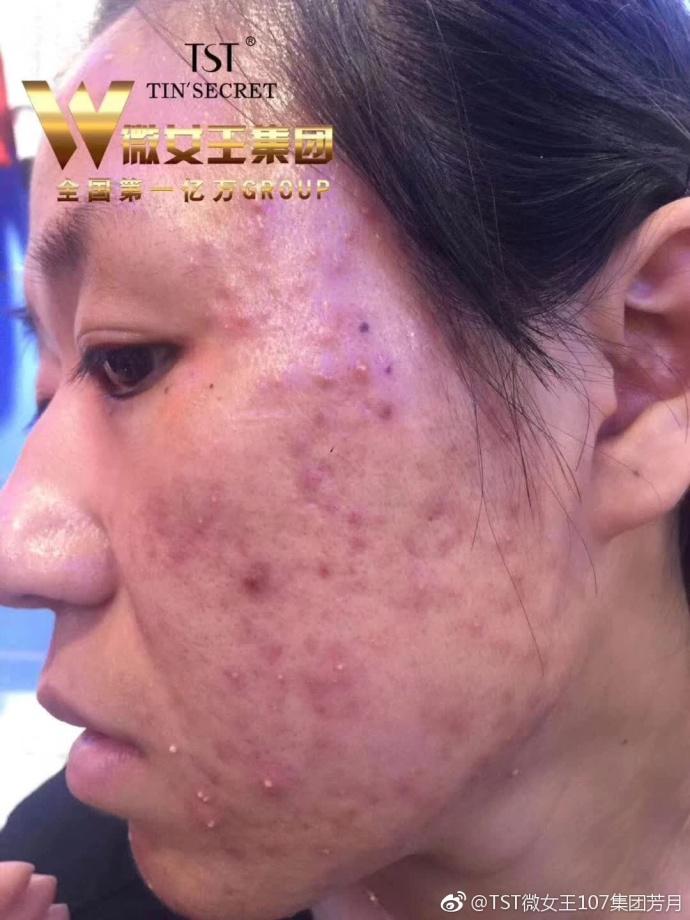 Acne Severity Classification Classification Dataset and Pre-Trained ... Acne Severity Classification Classification Dataset and Pre-Trained ...