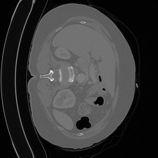 Lung Tumor Instance Segmentation Dataset By Kfupm