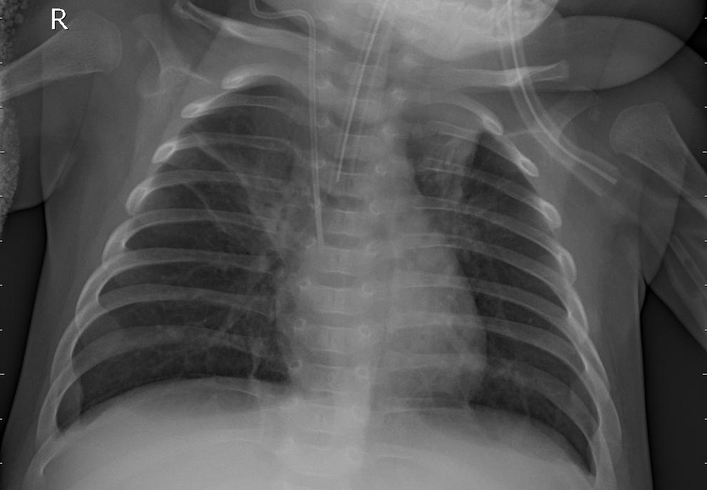 classify chest xray using haar Classification Model by Surbhi