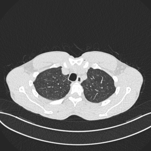 Lung Cancer Object Detection Dataset and Pre-Trained Model by Ella Azzahra
