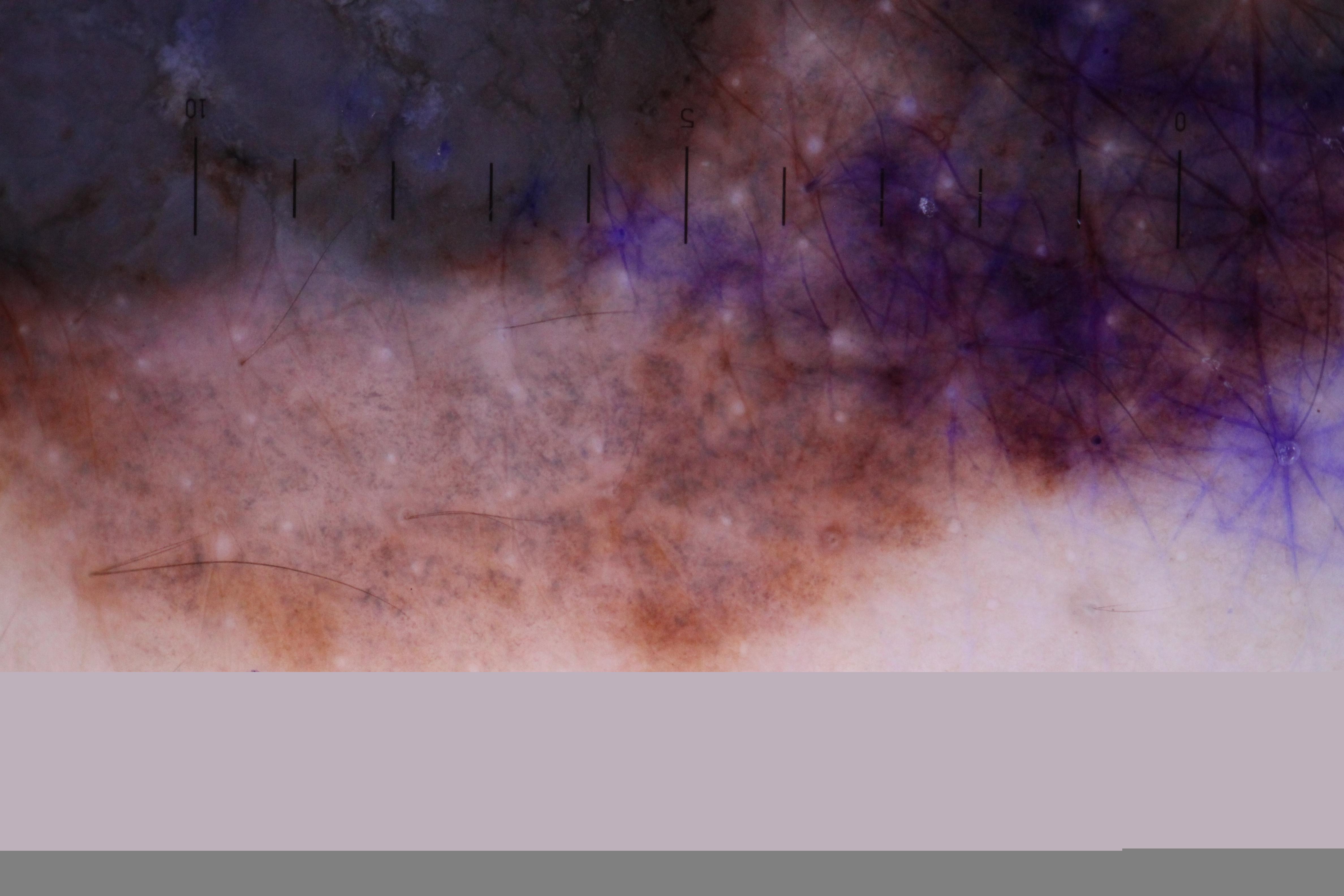 Skin cancer type comparison Classification Model by Skin cancer