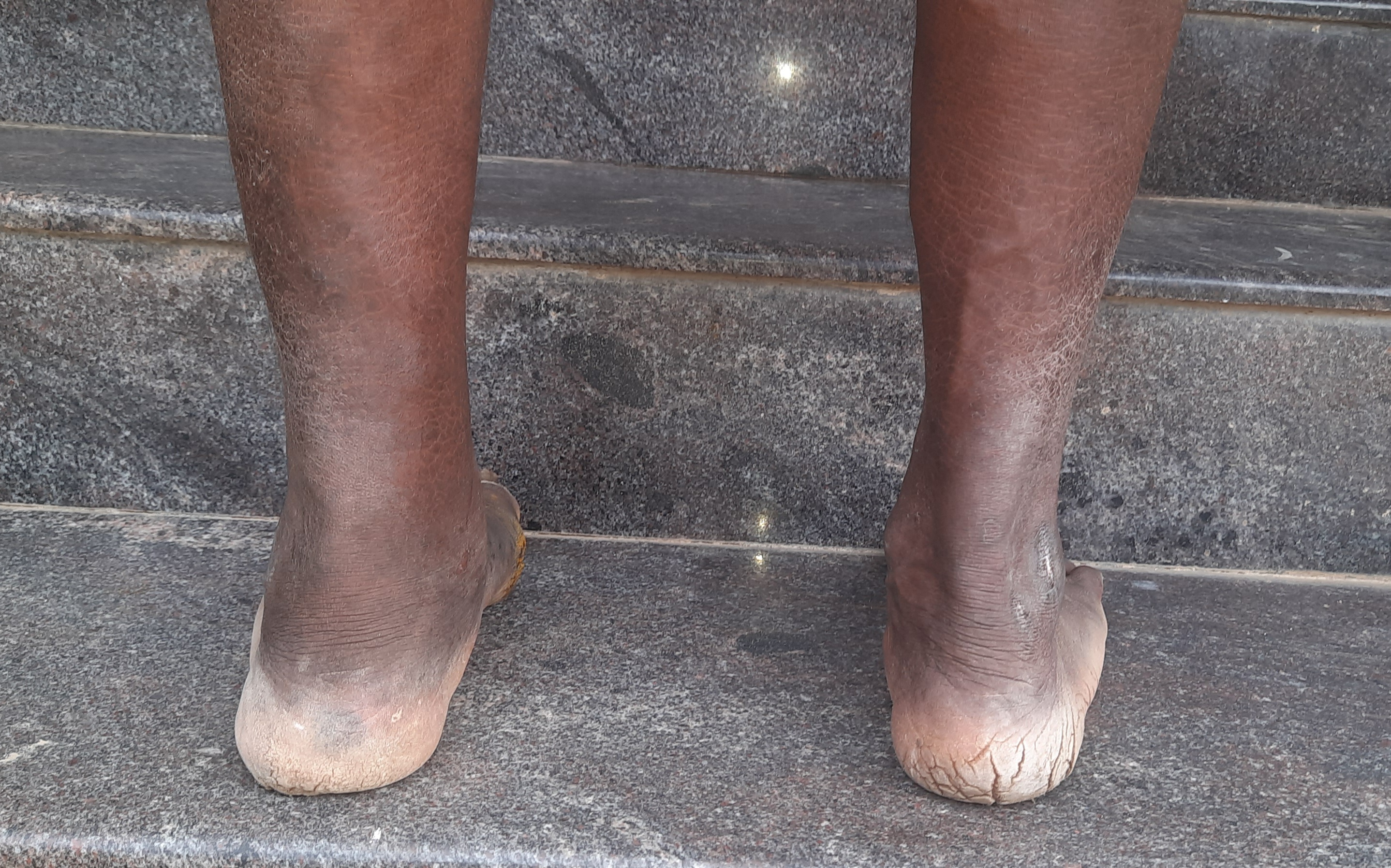 Normal_Foot Instance Segmentation Model by Test