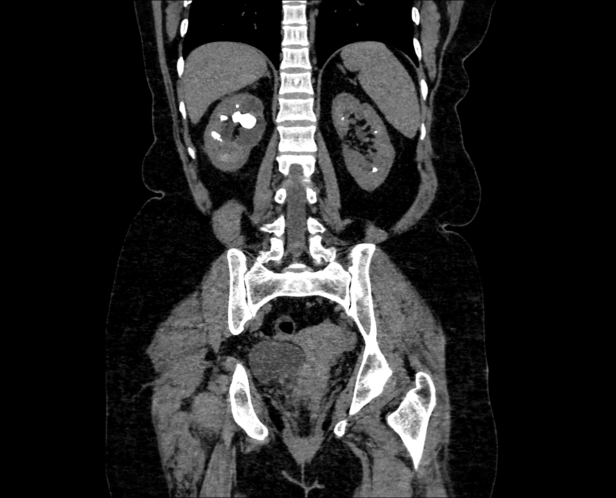 kidney_detection_and_crop Object Detection Dataset and Pre-Trained Model by stone
