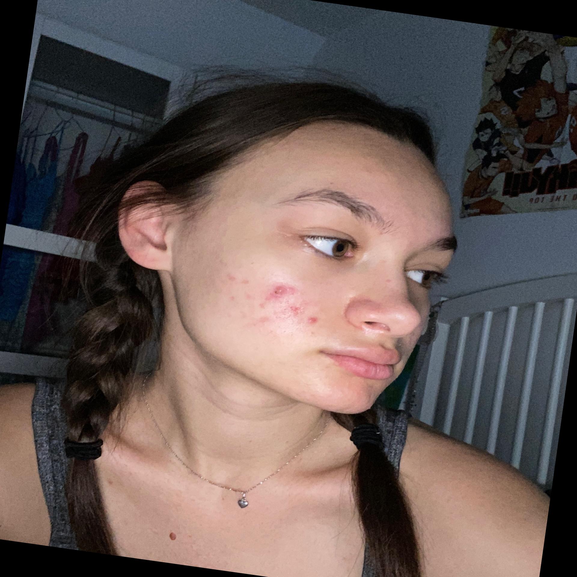 Skin Analysis Dataset Object Detection Dataset by SkinAnalysis