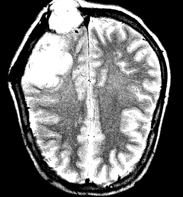 Brain Tumor Detection W Yolov8 Classification Model By Arjans Workspace
