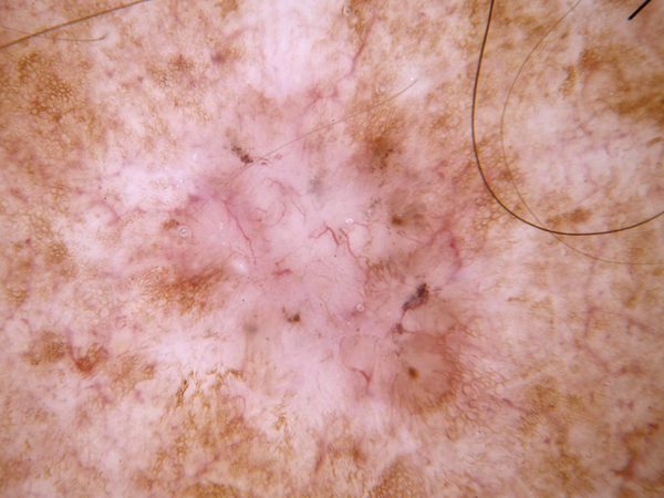 Skin-Cancer-Basal Object Detection Model by venkat