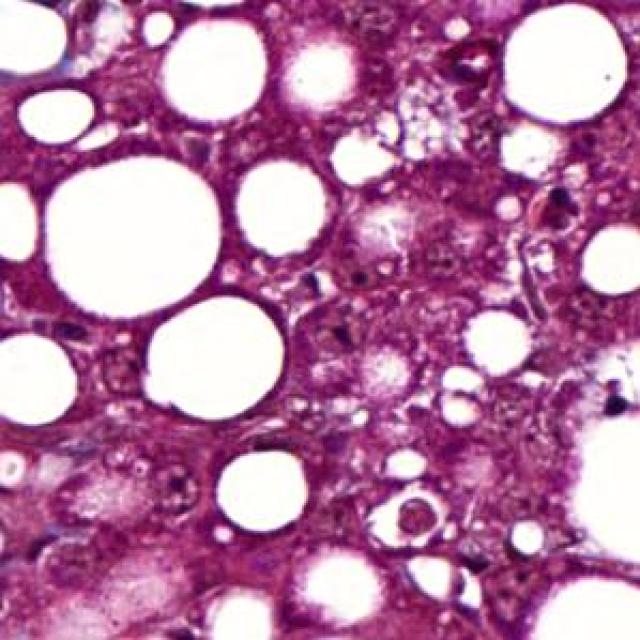 liver Abscess Object Detection Dataset by Master