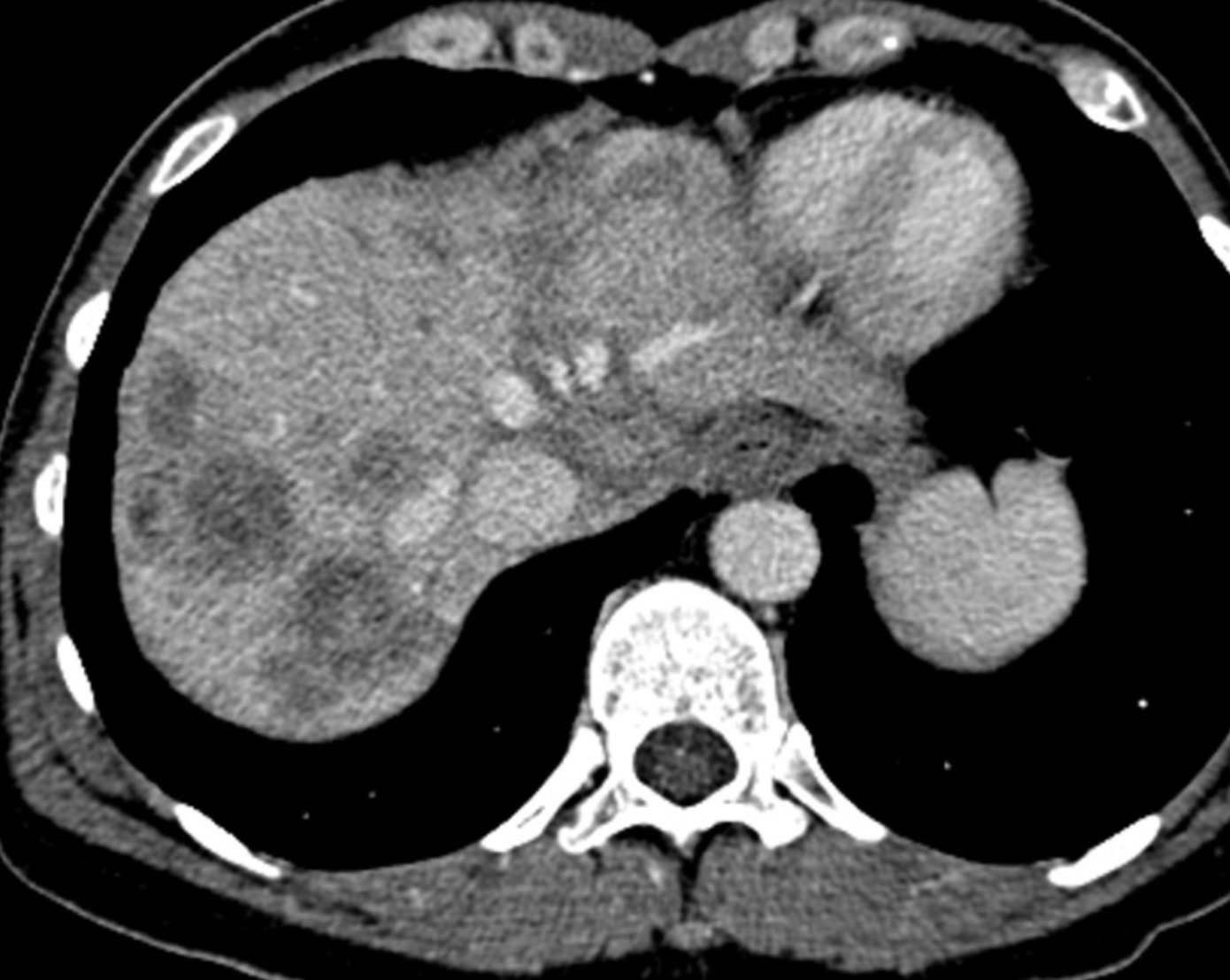 Focal Liver Lesion Classification Dataset And Pre Trained Model By Jhon Mark Blay