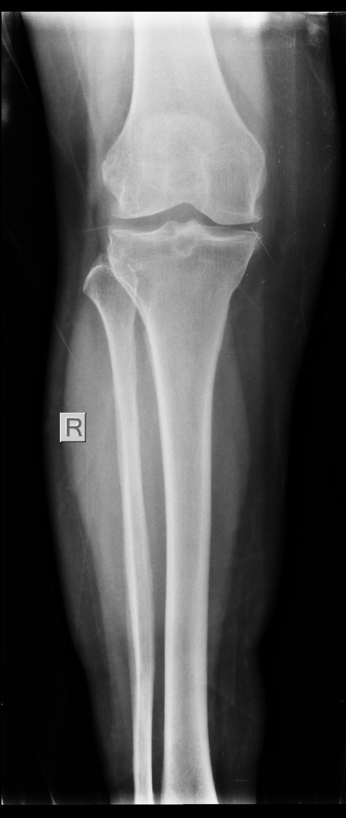 tibial spines Keypoint Detection Model by den