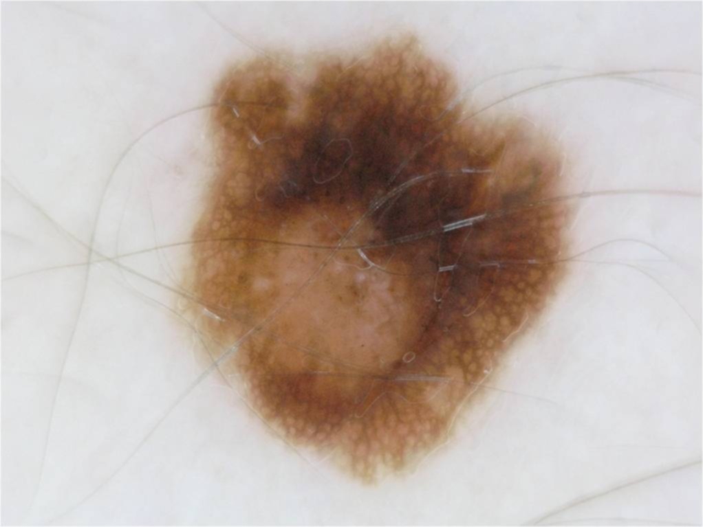 skin disease dataset Instance Segmentation Model (v38, 2024-06-05 2 ...