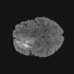 Brain Tumor Detection Object Detection Model by stuti thakur