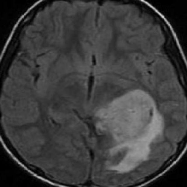 Brain Tumor Detection Dataset Object Detection Dataset by stuti thakur Brain Tumor Detection Dataset Object Detection Dataset by stuti thakur