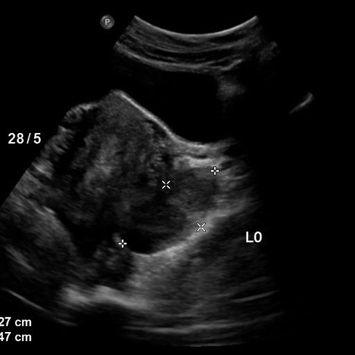 Ovarian cyst Detection Object Detection Model by Ovarian cyst