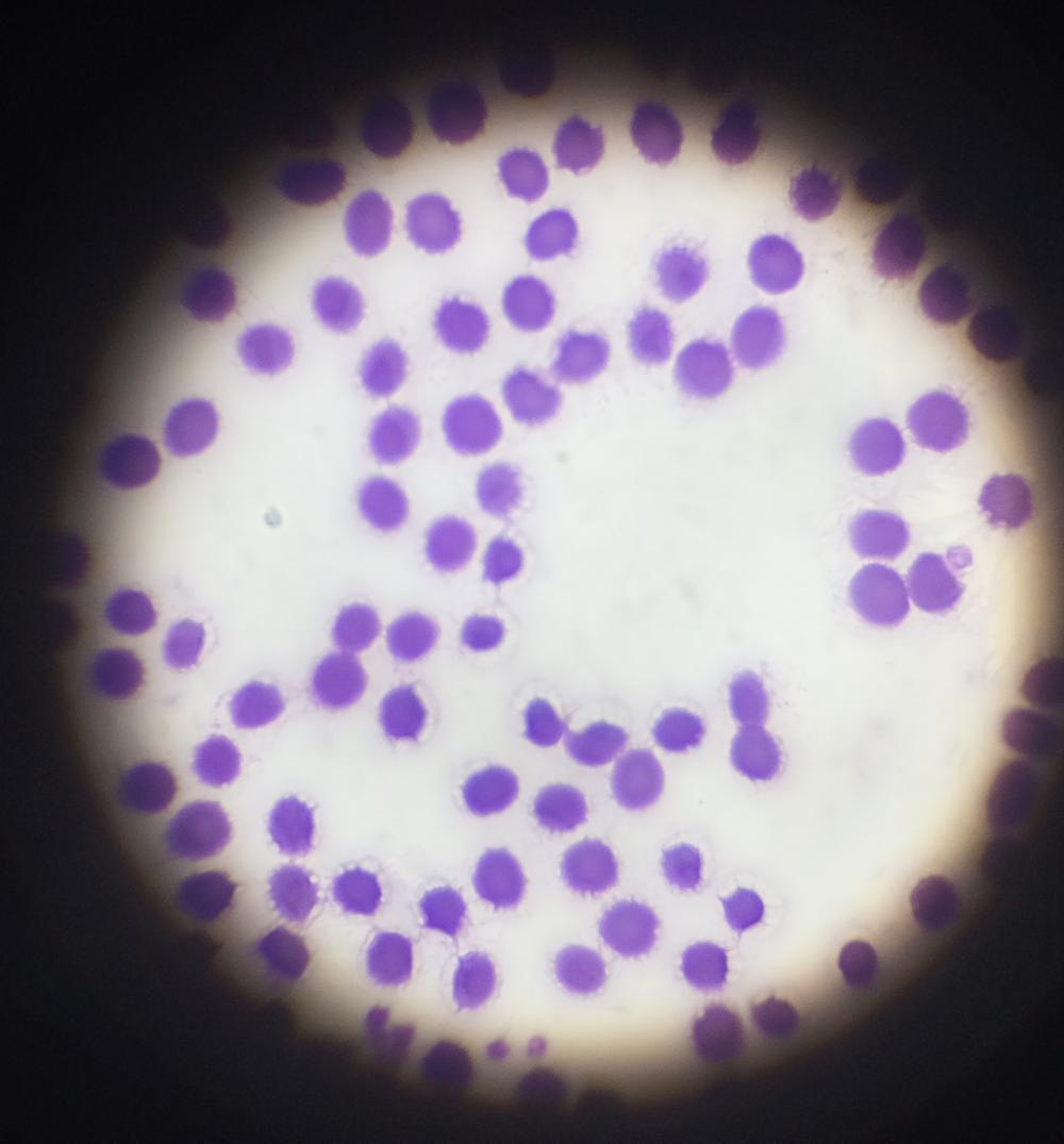 Sickled Cell Detector Object Detection Dataset By Nids Workspace