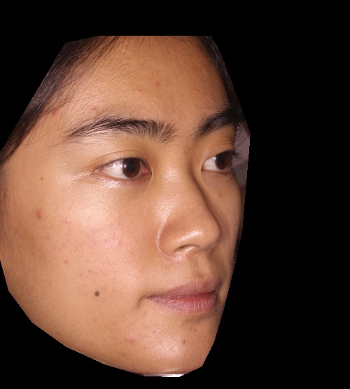 Acne Object Detection Dataset And Pre Trained Model By Acne