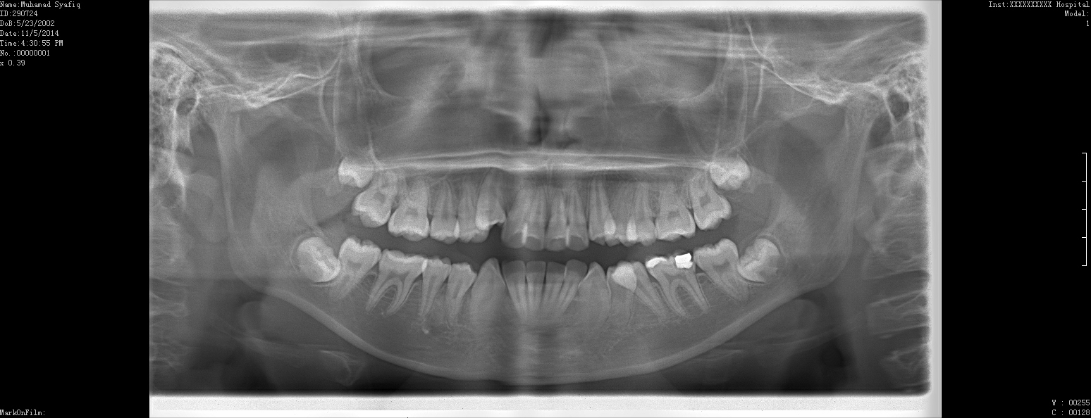 Teeth Detection Instance Segmentation Dataset And Pre Trained Model By