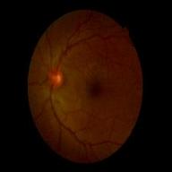 Diabetic Retinopathy (GP33) Classification Model by Jlaestologa