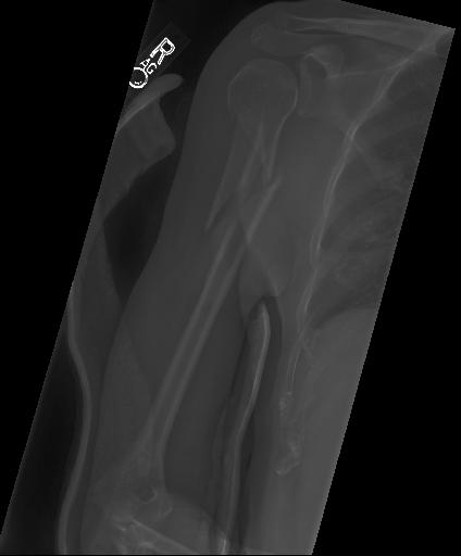 Bone Fracture Prediction Model Object Detection Dataset And Pre Trained